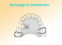 Anchorage in Orthodontics - Focus Dentistry