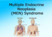 Multiple Endocrine Neoplasia (MEN) Syndrome - Focus Dentistry