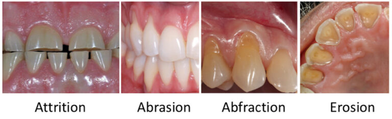 Non Carious Lesions - Focus Dentistry