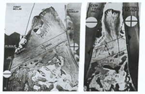 Trauma From Occlusion - Focus Dentistry