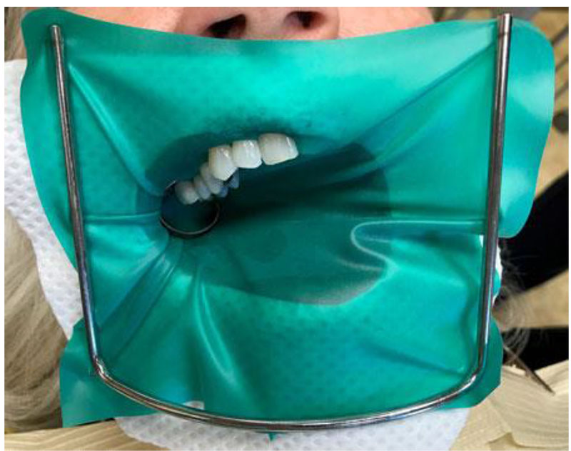 Rubber Dam Focus Dentistry