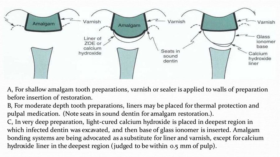 Fundamentals Of Tooth Preparation Part 2 Focus Dentistry Fundamentals Of Tooth Preparation Part 2 Focus Dentistry